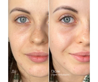 Професійна маска для карбоксітерапії для домашнього застосування DJ Carborn Carboxy CO2 Gel Mask ...